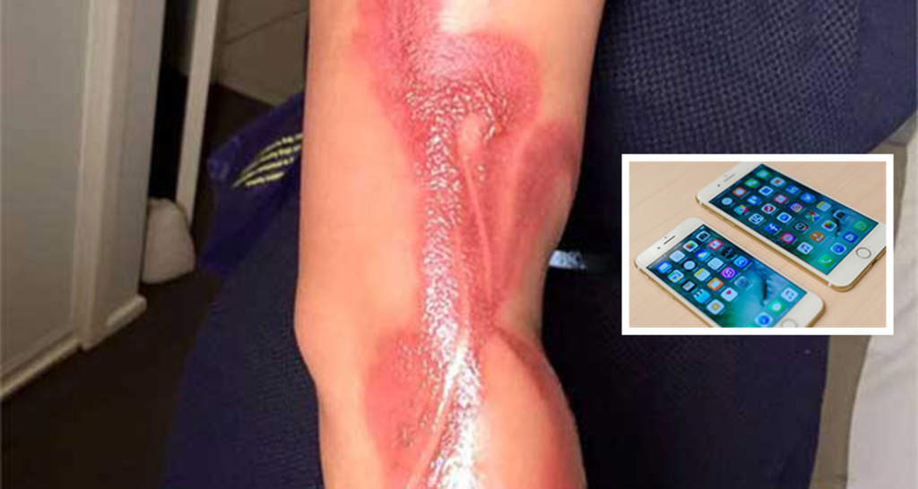 Quemaduras de segundo grado provocadas por un iPhone 7