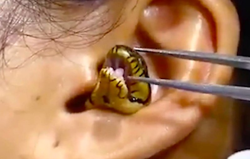 Video De Una Serpiente Atorada En El Oído De Una Mujer