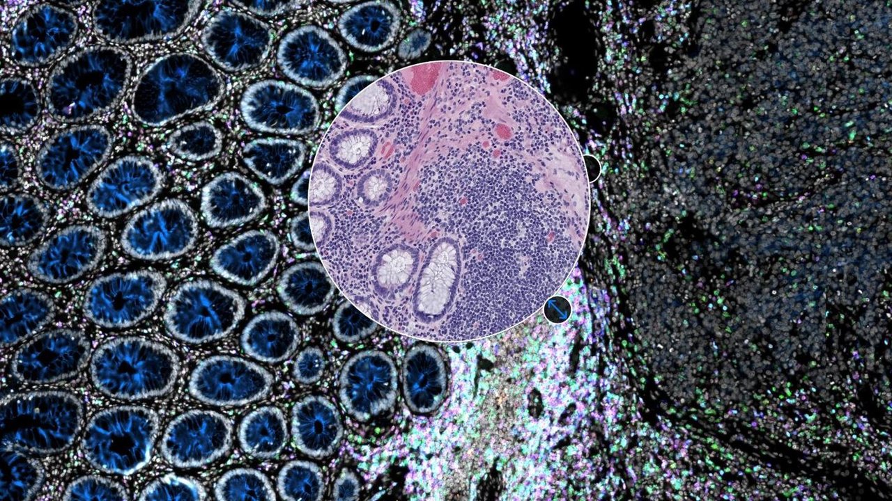 Orion, para diagnosticar el cáncer Orion, para diagnosticar el cáncer