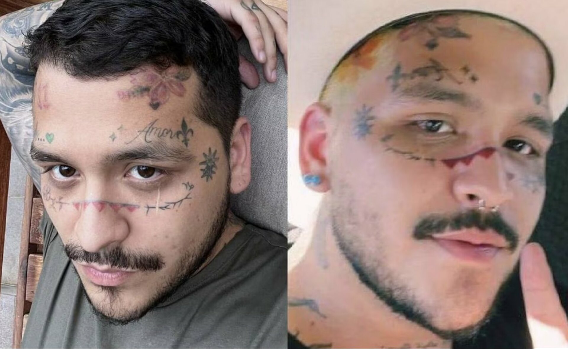 Así Luce El Rostro De Christian Nodal Tras Iniciar Su Tratamiento Para